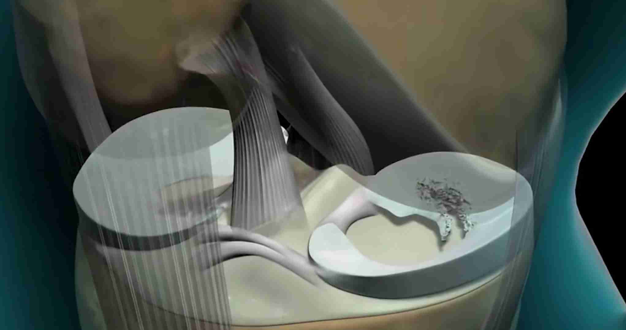 Shaver Systems | Arthroscopy | Grandtek Medical